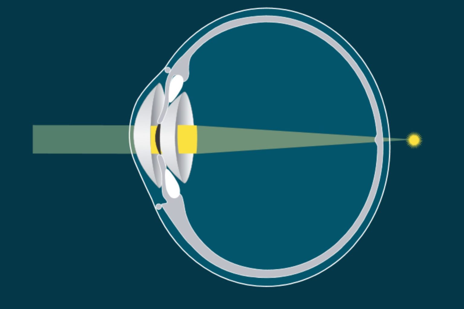 En savoir plus sur l'opération de l'hypermétropie - Medinations